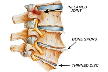 Cervical Degenerative Disc Disease - Collier Chiropractic and Accident ...